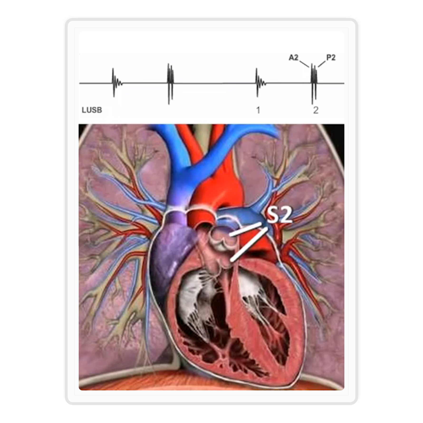 Heart Sounds | MedStudy